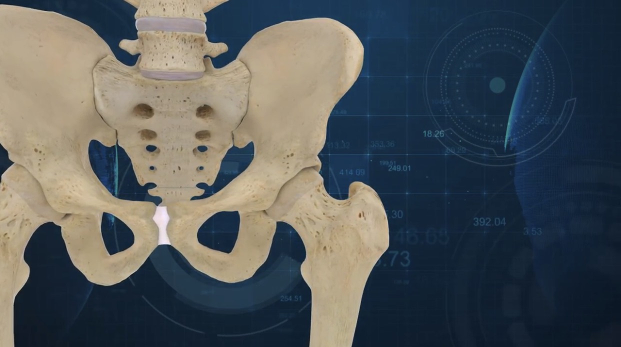 Conformis Announces FDA 510(k) Clearance for iTotal Hip System | Conformis
