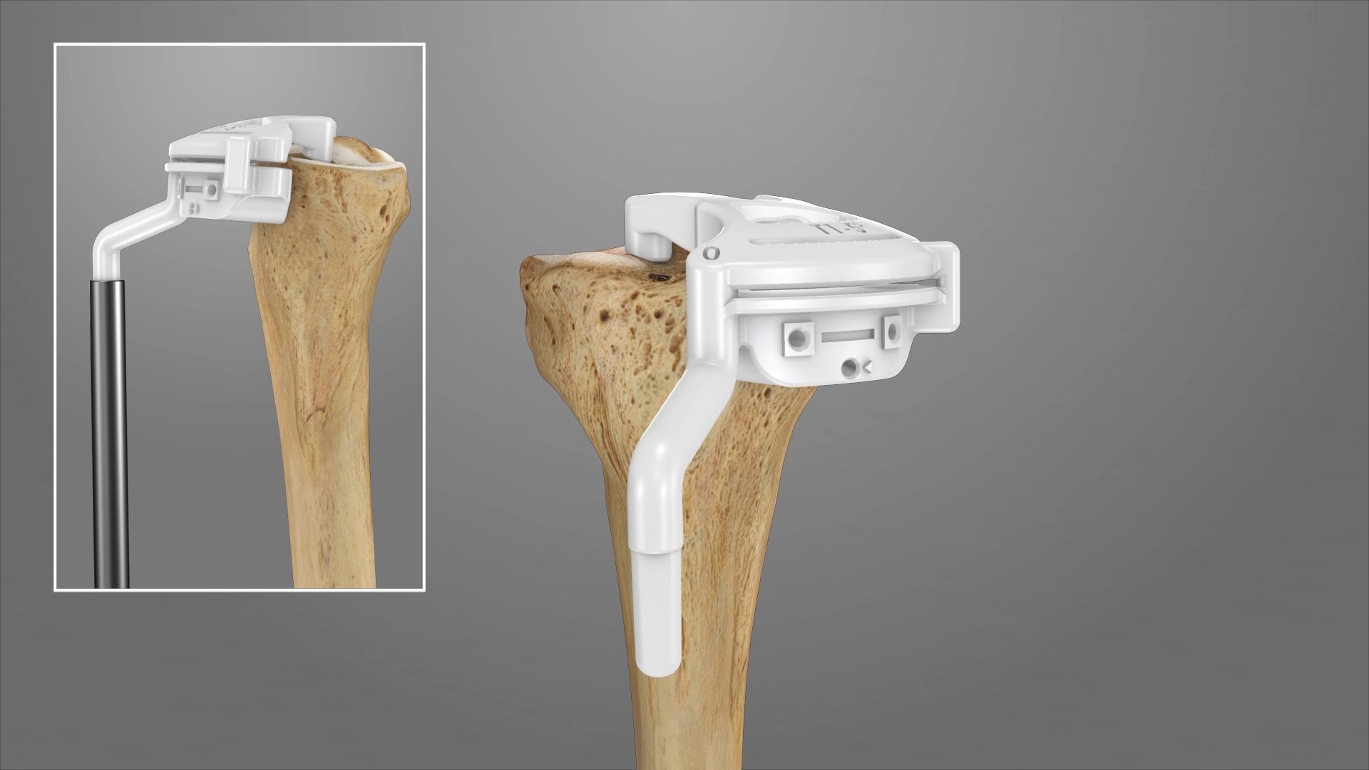 iTotal CR Surgical Technique Animation | Conformis