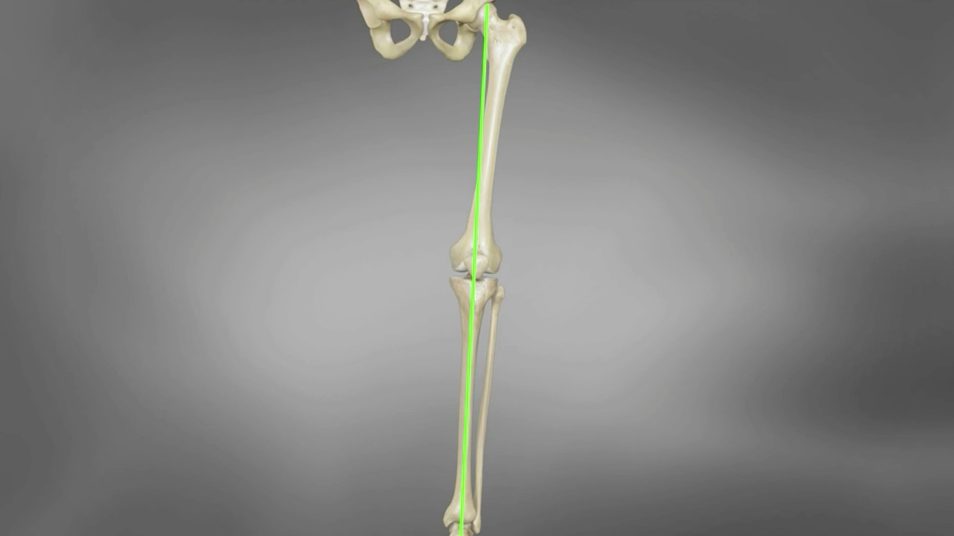 Neutral mechanical alignment: reliable and reproducible | Conformis