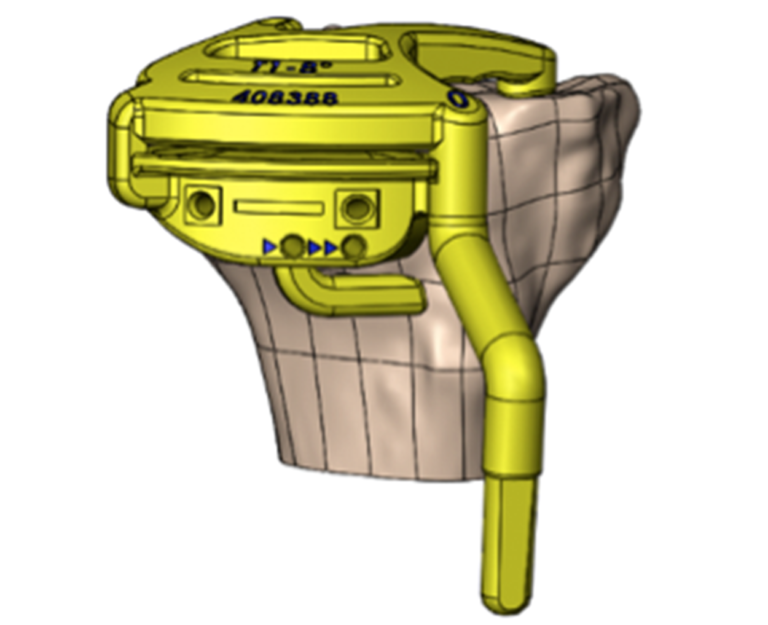 NEW: Updated iTotal CR iJigs and Surgical Plan | Conformis