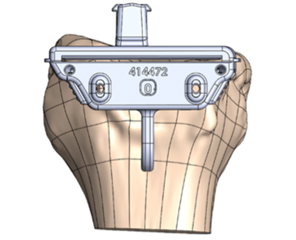 NEW: Updated iTotal CR iJigs and Surgical Plan | Conformis