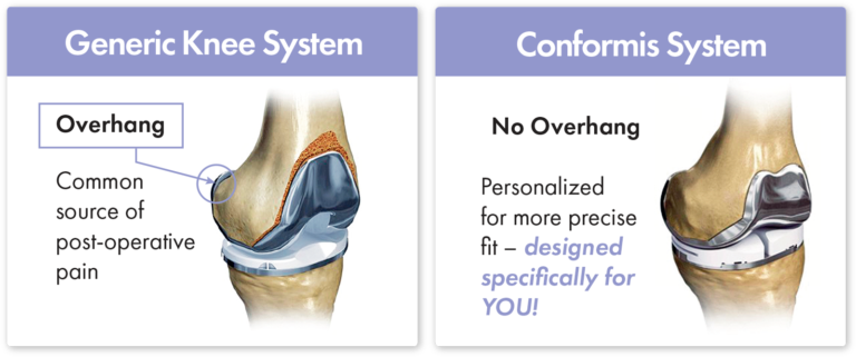 Upgrade My Knee | Conformis